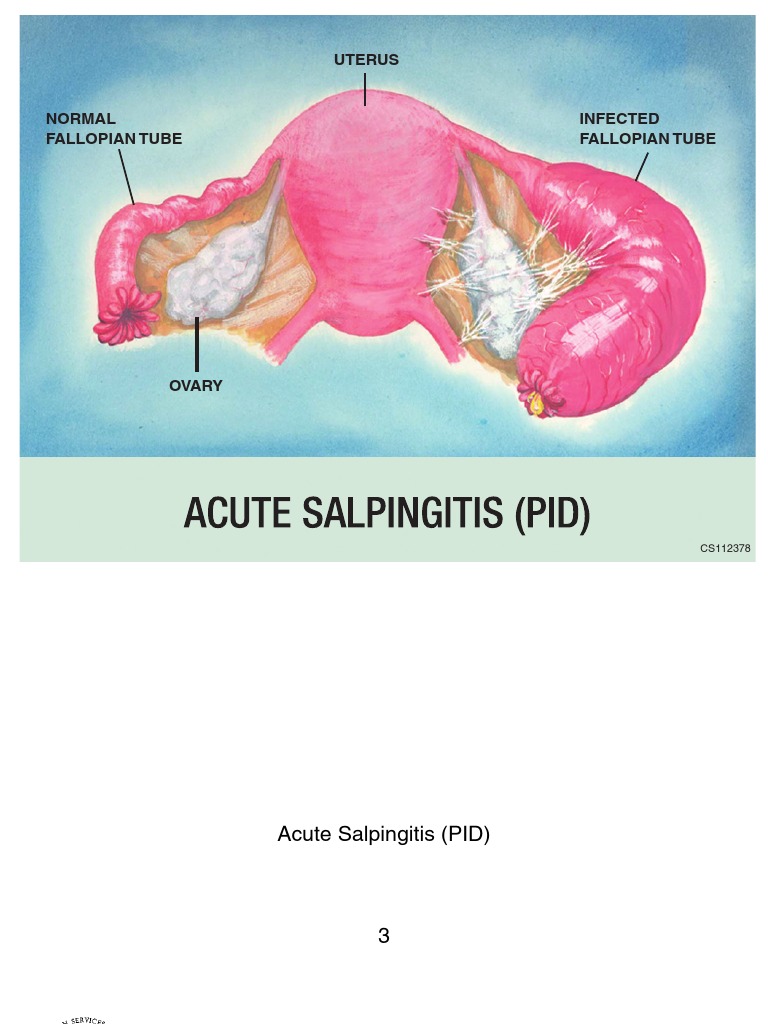 Understanding Acute Salpingitis: A Comparison of Normal and Infected ...