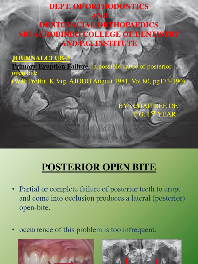 Journalclub-3: Primary Eruption Failure | PDF | Orthodontics | Human Tooth