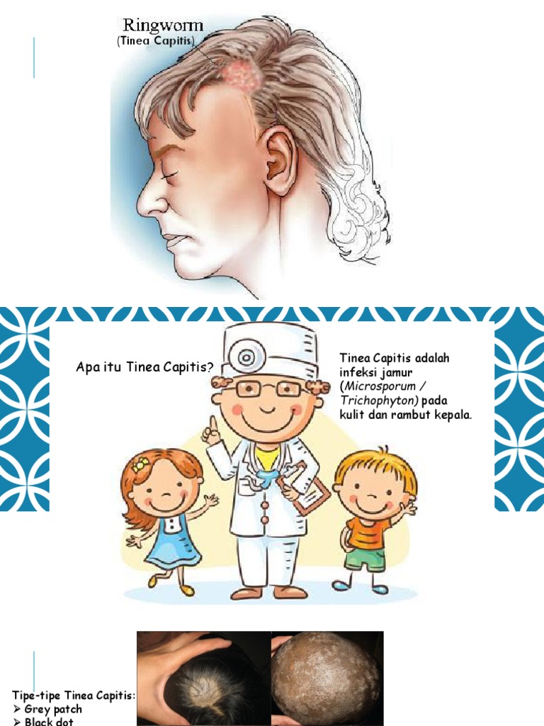 Powerpoint Ringworm (Tinea Capitis) | PDF