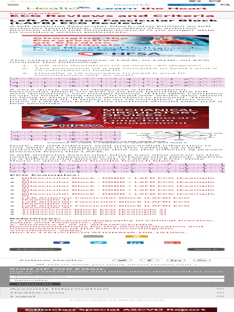 Left Anterior Fascicular Block (LAFB) ECG Review - Criteria and ...