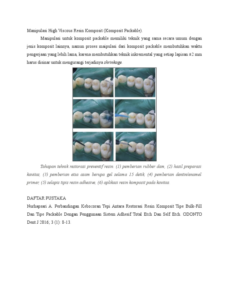 Manipulasi High Viscous Resin Komposit Pdf