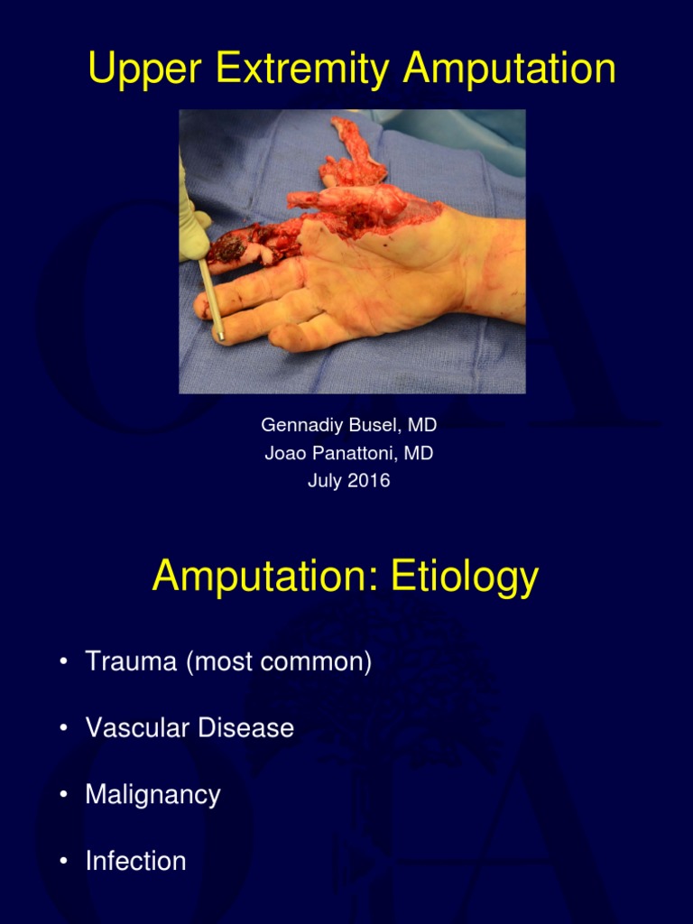 Upper Extremity Amputation | PDF | Amputation | Finger