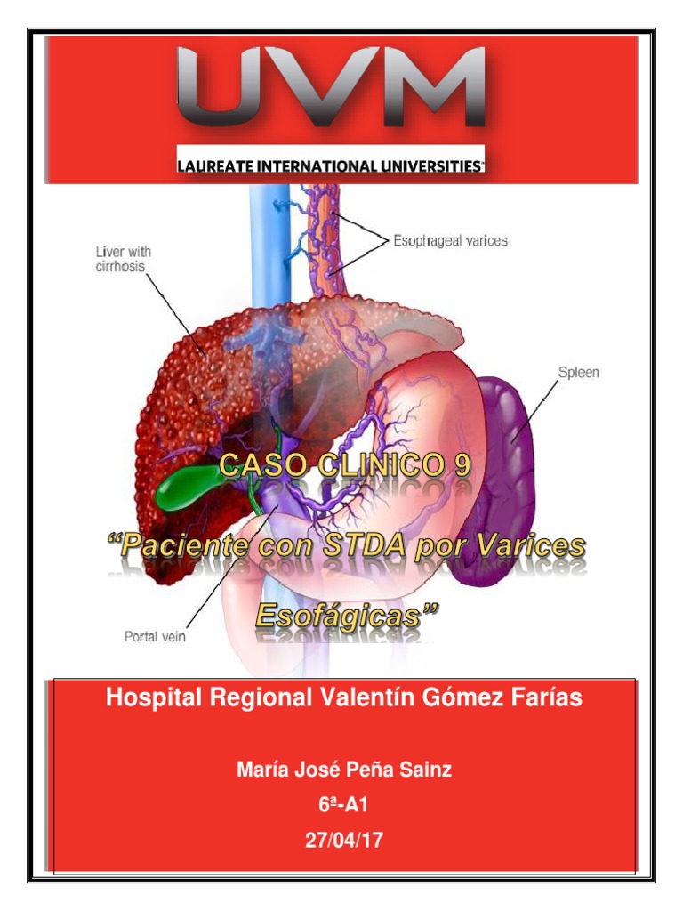 caso clinico varices esofagicas | Cirrosis | Enfermedades y trastornos