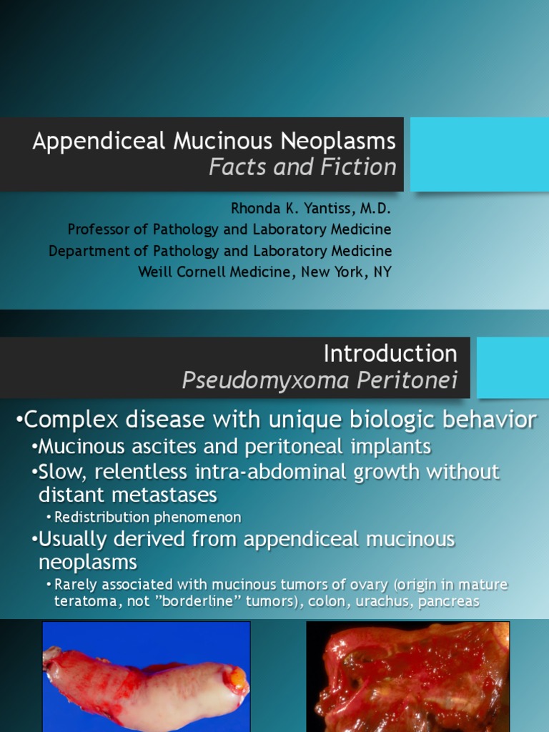 Appendix Mucinous Neoplasms | PDF | Neoplasms | Medical Specialties