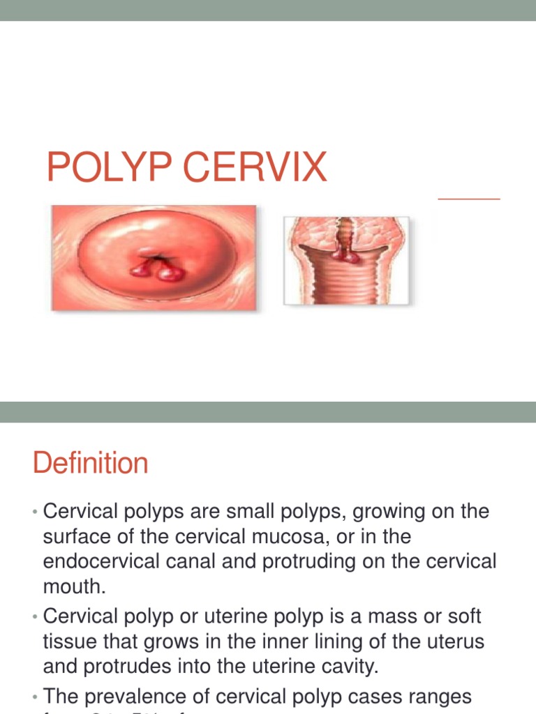 Polyp Cervix Vagina Uterus