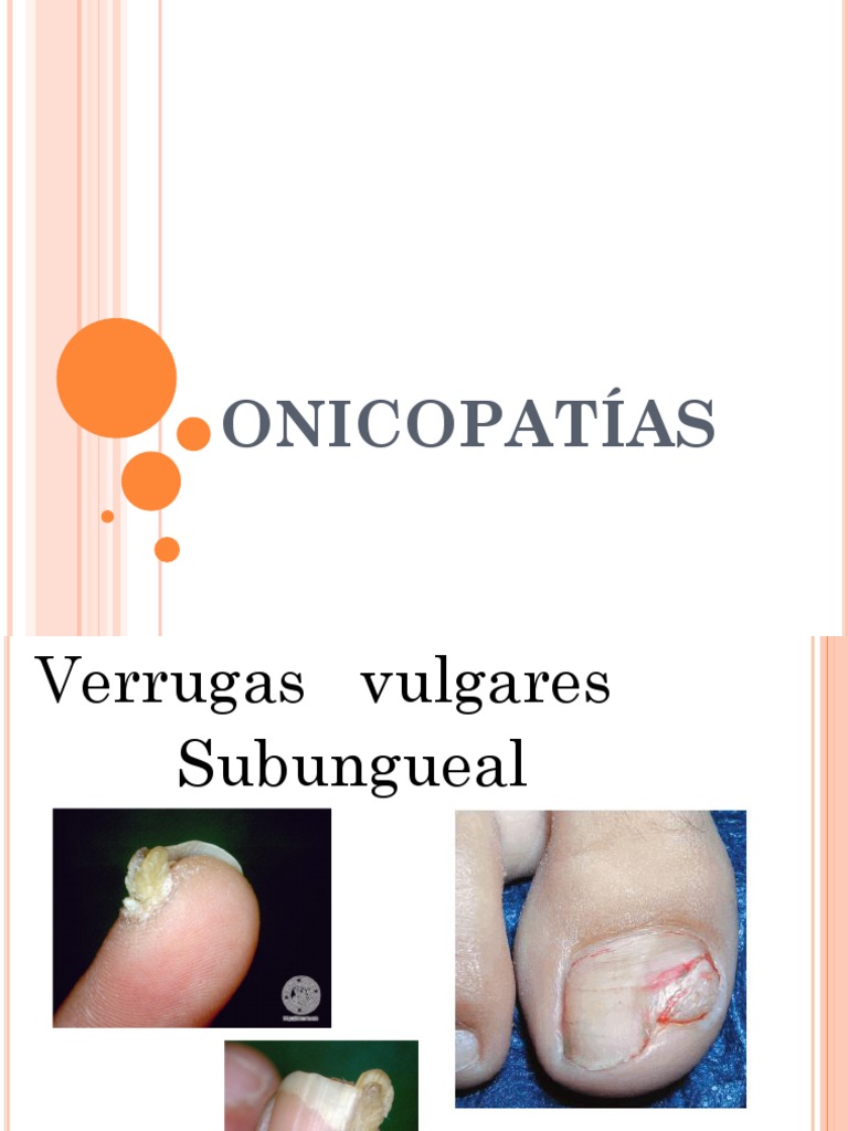 Onicopatias 5 | PDF | Clavo (anatomía) | Inflamación