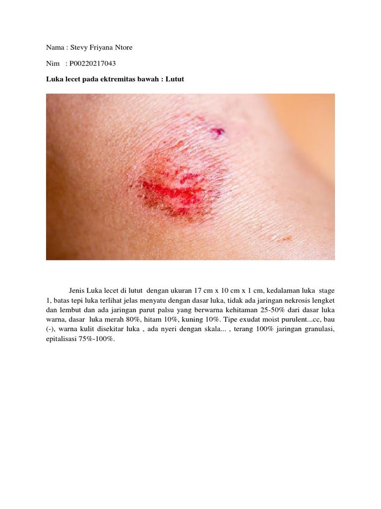 Luka Lecet Pengkajian Bates | PDF