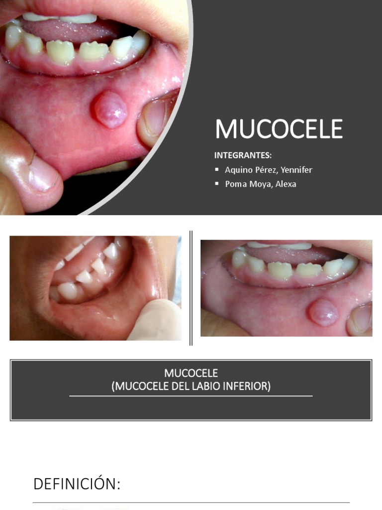 Mucocele | PDF | Medicina | Medicina CLINICA