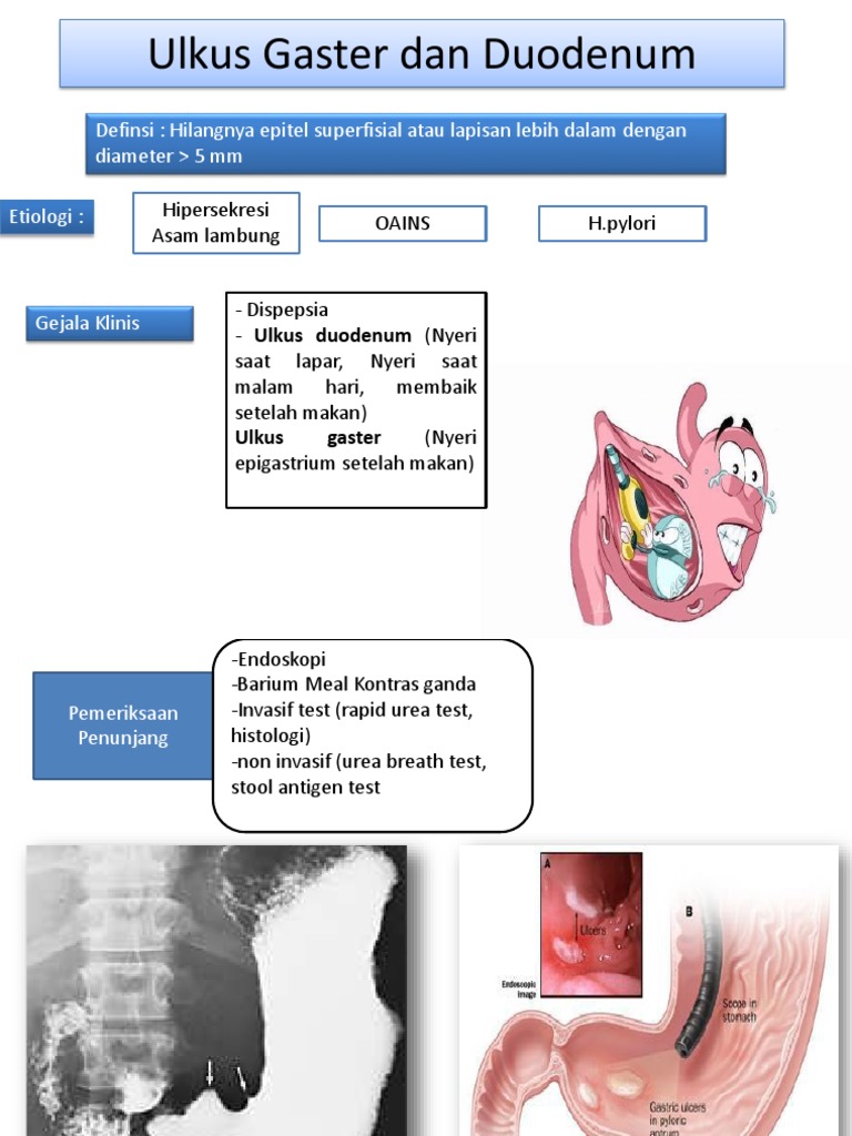 Ulkus Gaster Dan Duodenum - Stephanus | PDF