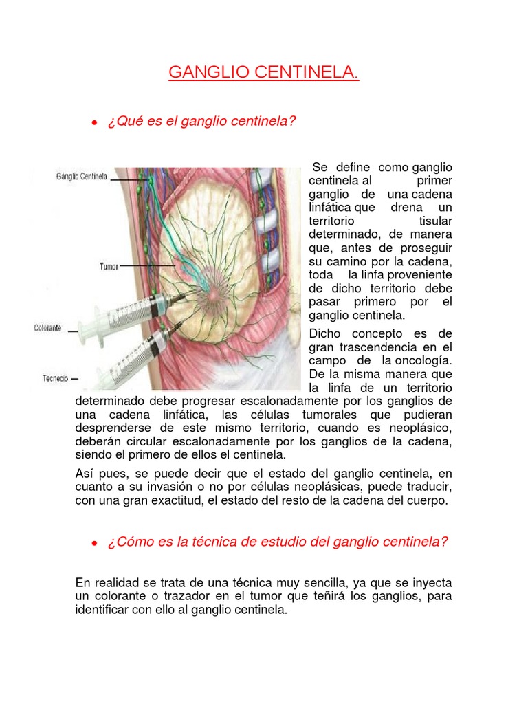 Definición y técnica del ganglio centinela | PDF | Cáncer de mama | Cáncer