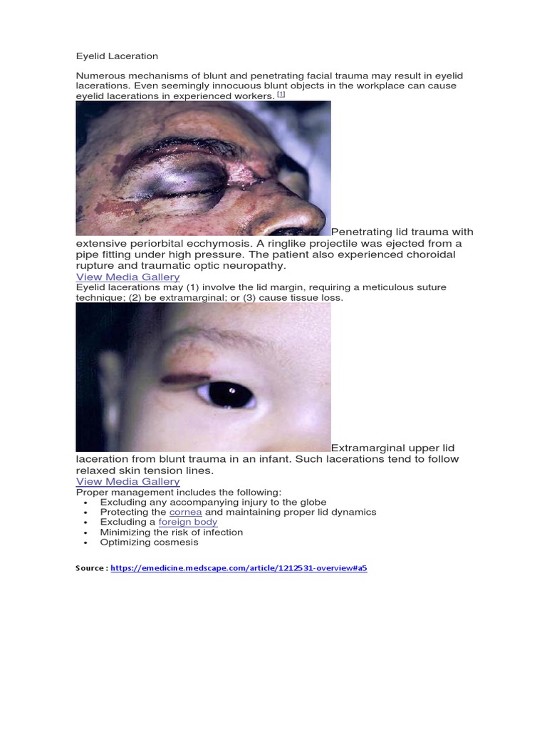 Eyelid Laceration Treatment: Evaluating and Repairing Injuries to the ...