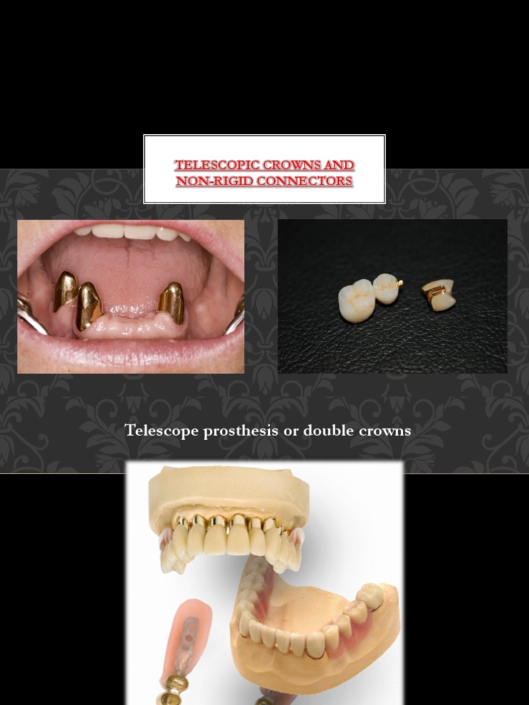 Telescopic Crowns and Non-Rigid Connectors | PDF | Soldering | Materials