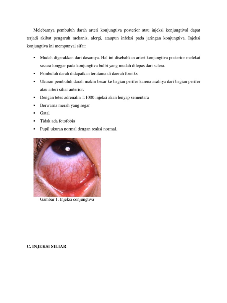 C. Injeksi Siliar | PDF