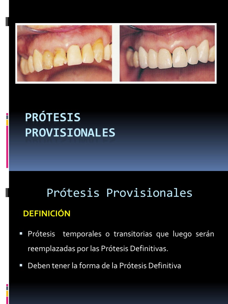 Protesis Provisional | PDF | Dentadura postiza | Ramas de Odontología