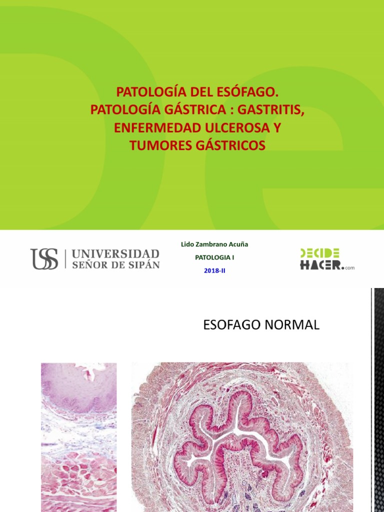 Uss 2018-Ii. - Patologia Del Esófago y Estómago. - 29 Oct 2018 | PDF ...