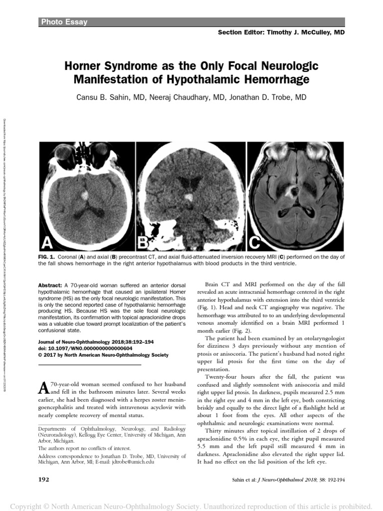 Horner Syndrome As The Only Focal Neurologic Manifestation of ...