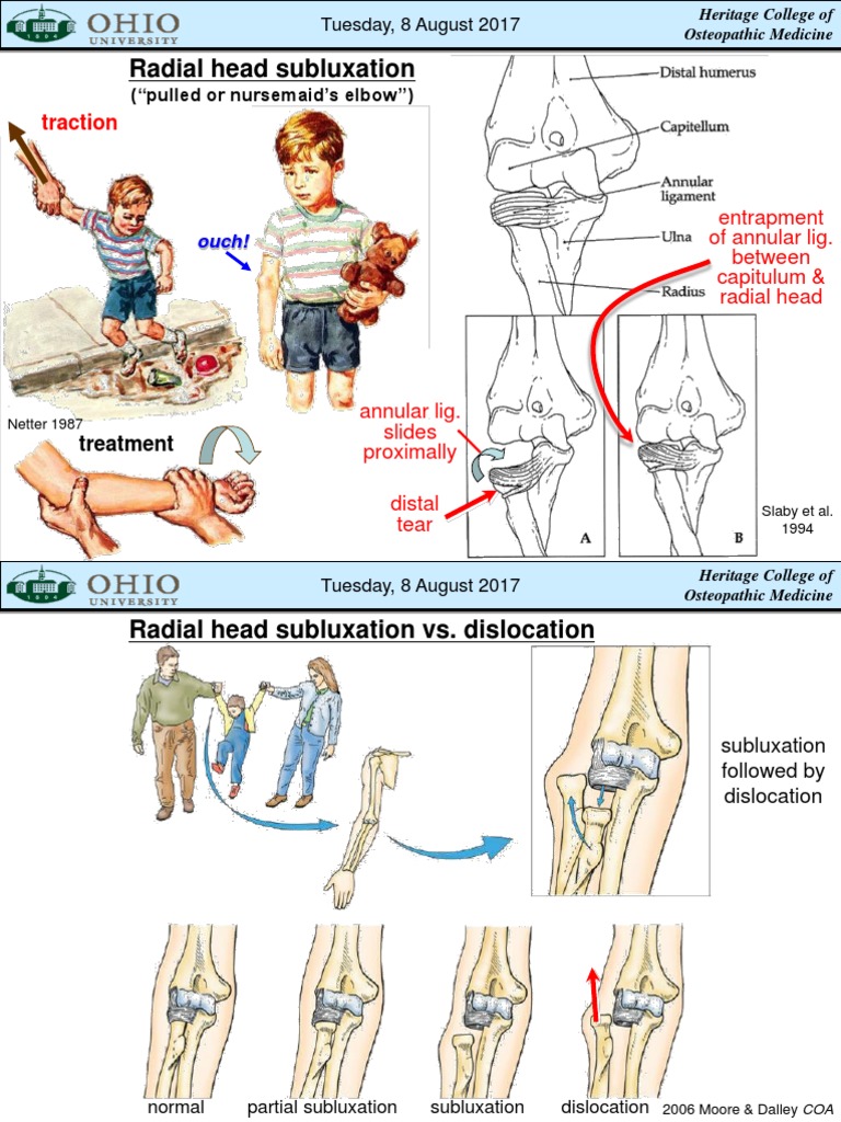 Radial Head Subluxation: Traction | PDF | Traumatology | Injury