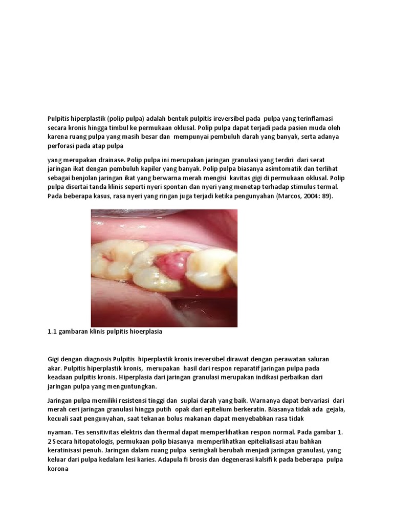 Pulpitis Hiperplasia | PDF | Sains & Matematika