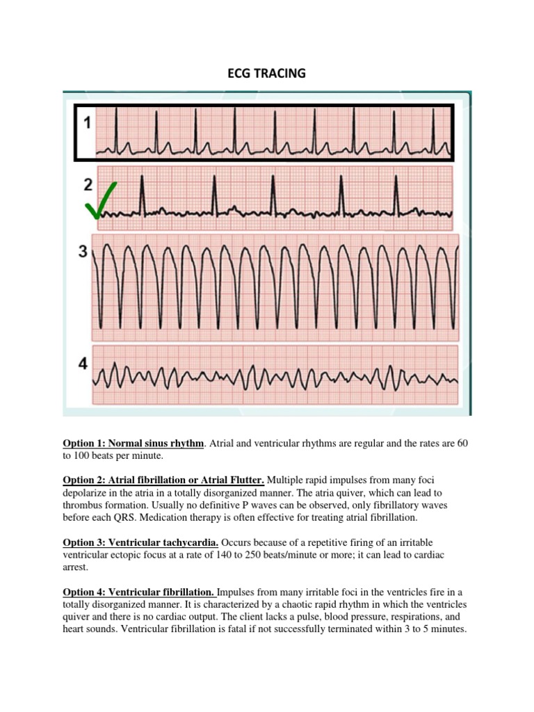 ECG Tracings: Types and Interpretations | PDF | Art | Wellness