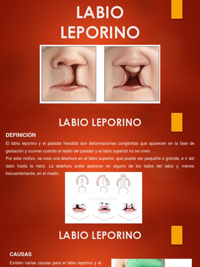 Labio Leporino Elizabeth | PDF | Epidemiología | Rtt