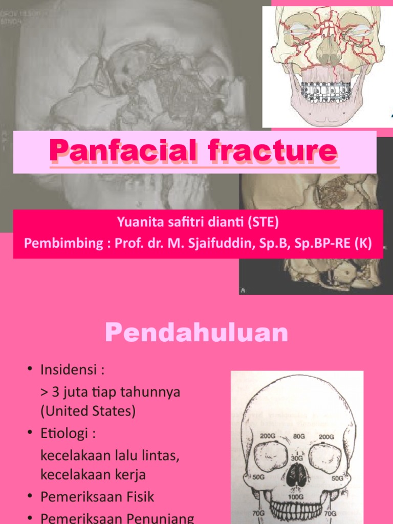 Panfacial Fracture | PDF