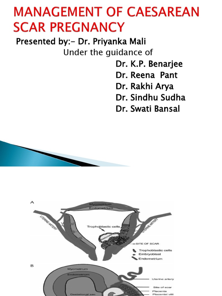 Managment of Scar Pregnancy | PDF | Medical Ultrasound | Pregnancy