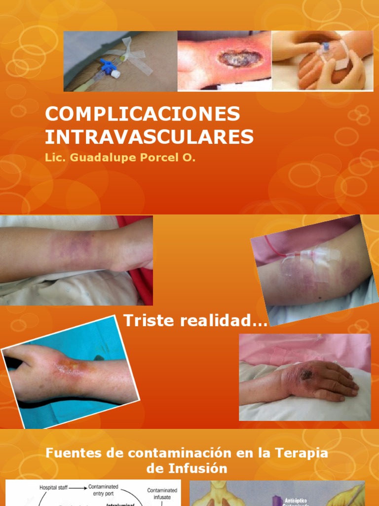 Complicaciones Intravasculares | PDF | Terapia intravenosa | Medicina