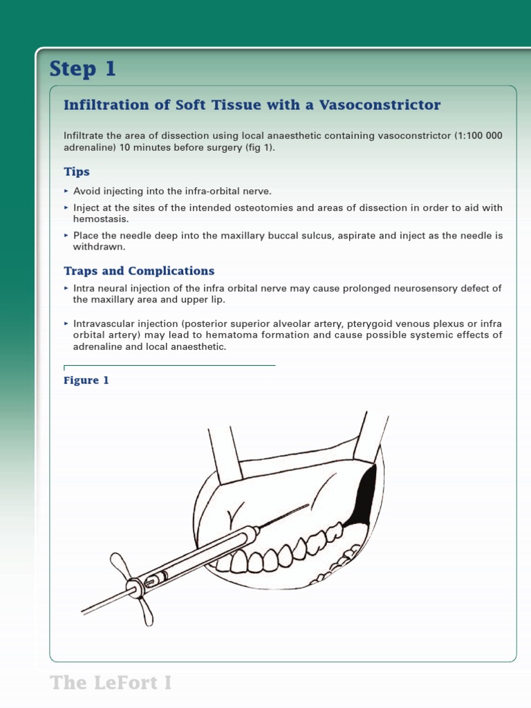 Step 1: Infiltration of Soft Tissue With A Vasoconstrictor | PDF