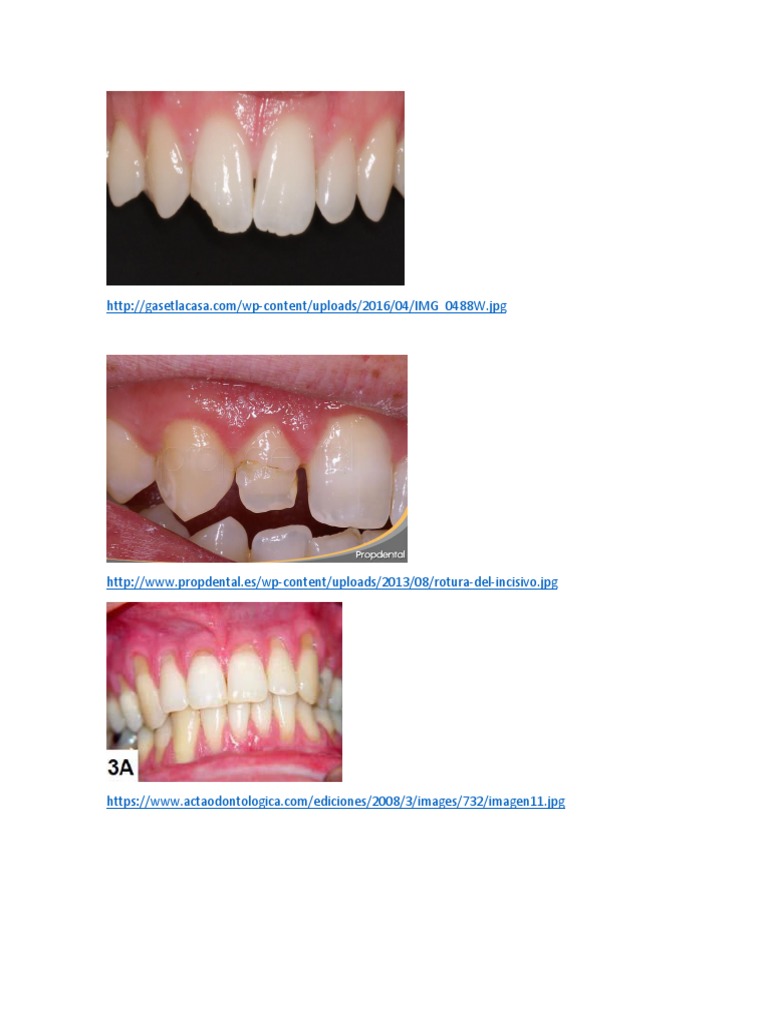 Imagenes de Dientes Fracturados. | PDF | Ortodoncia | Odontología