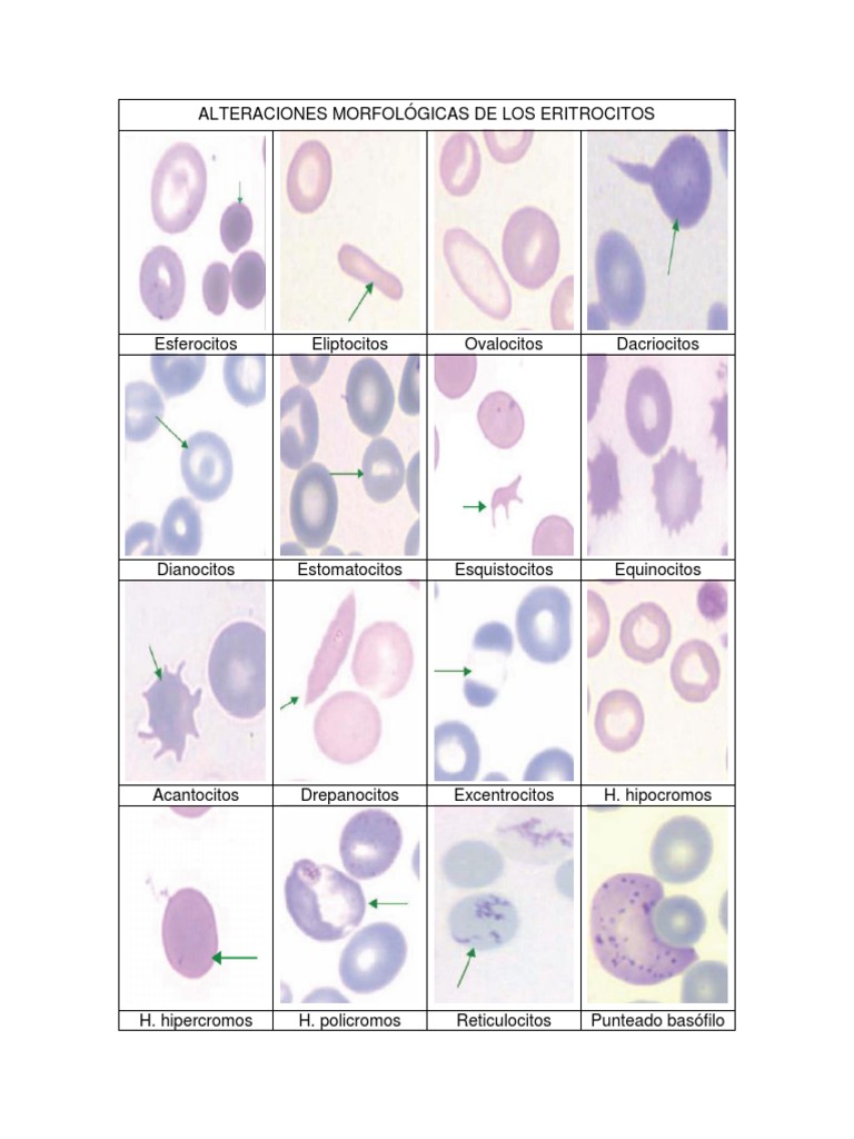 Alteraciones Morfológicas de Los Eritrocitos | PDF
