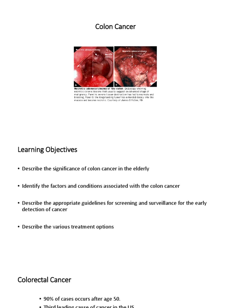 Colon Cancer | PDF | Colorectal Cancer | Cancer