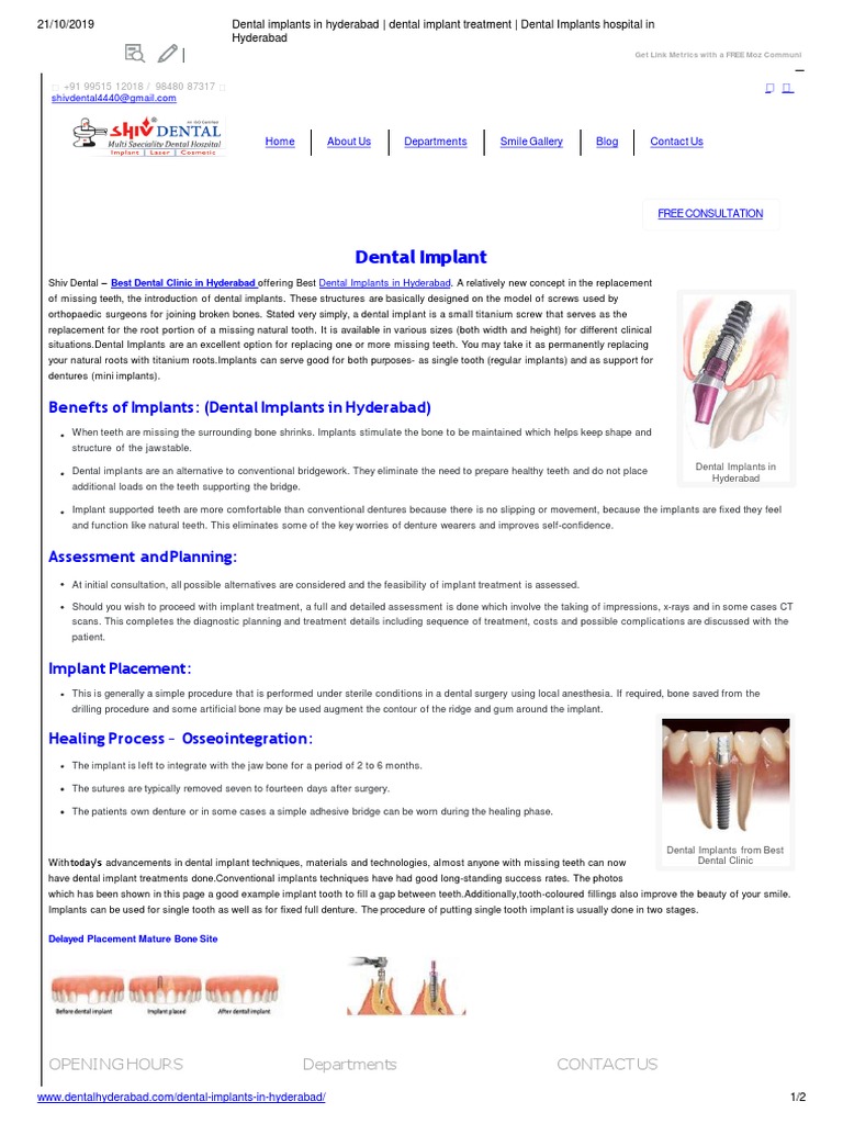 Dental Implants | PDF | Dental Implant | Dentures
