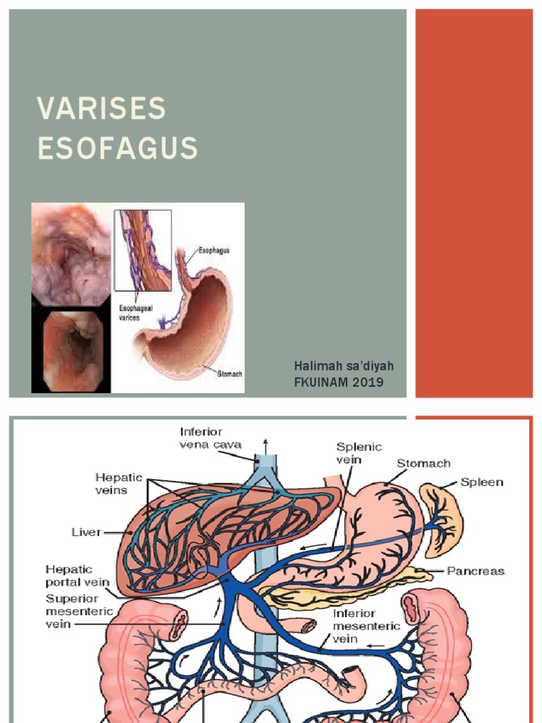 Varises Esofagus | PDF