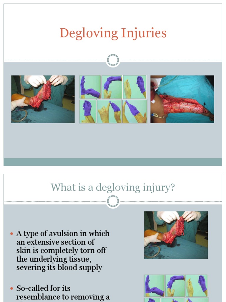 Degloving Injury Management