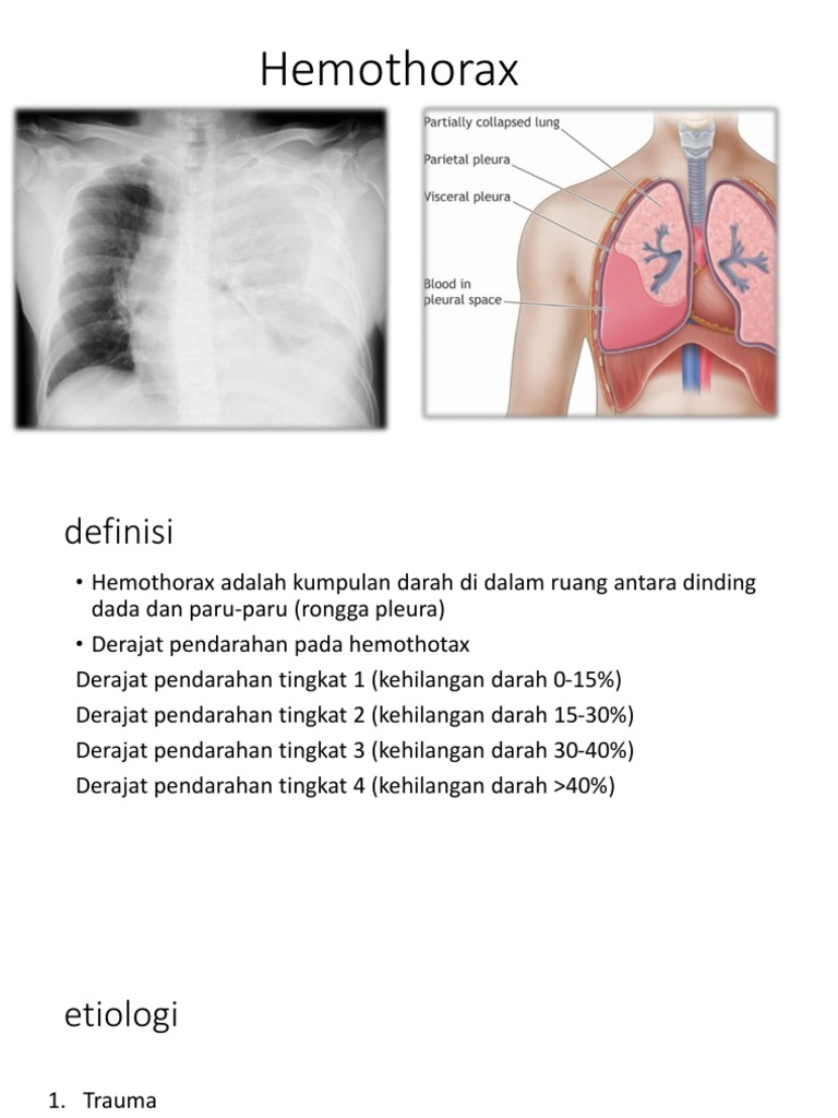 Hemothorax | PDF | Perjalanan