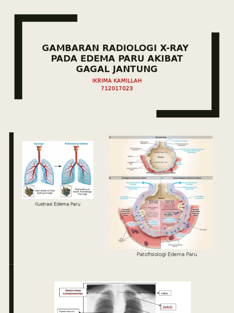 Gambaran Radiologi X-Ray Pada Edema Paru Akibat Gagal Jantung | PDF
