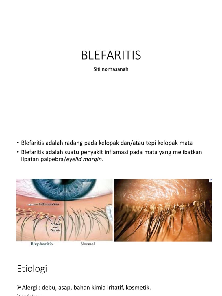 Blefaritis | PDF | Kesehatan Holistik