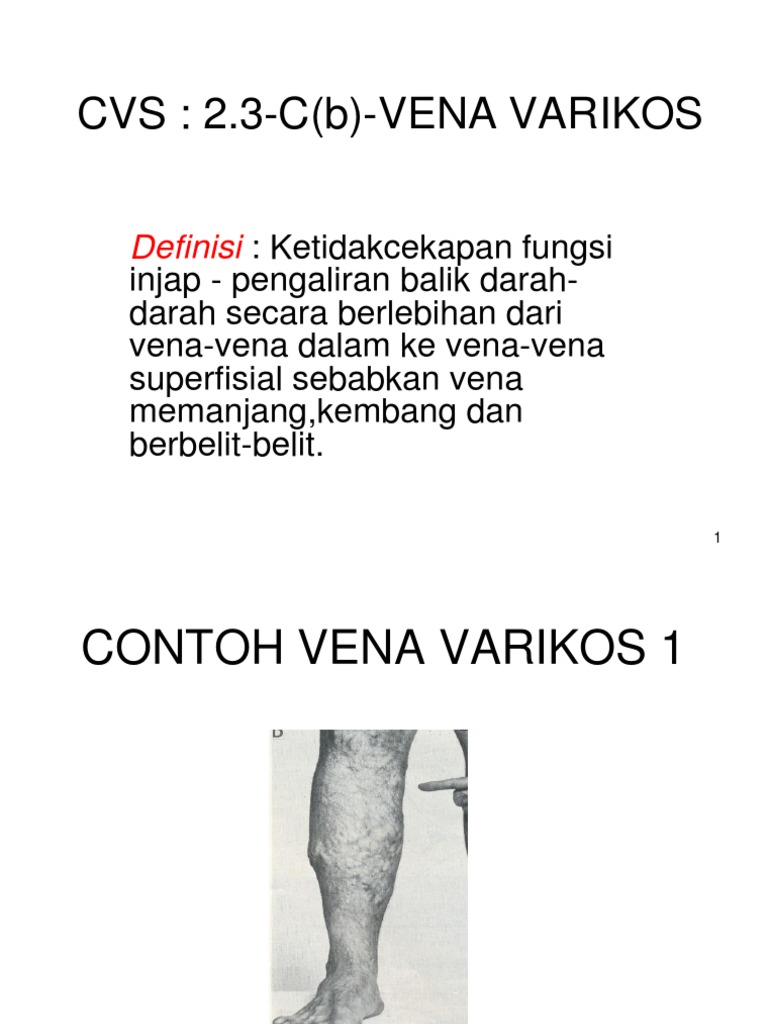 Rawatan dan Komplikasi Vena Varikos | PDF | Sains & Matematika