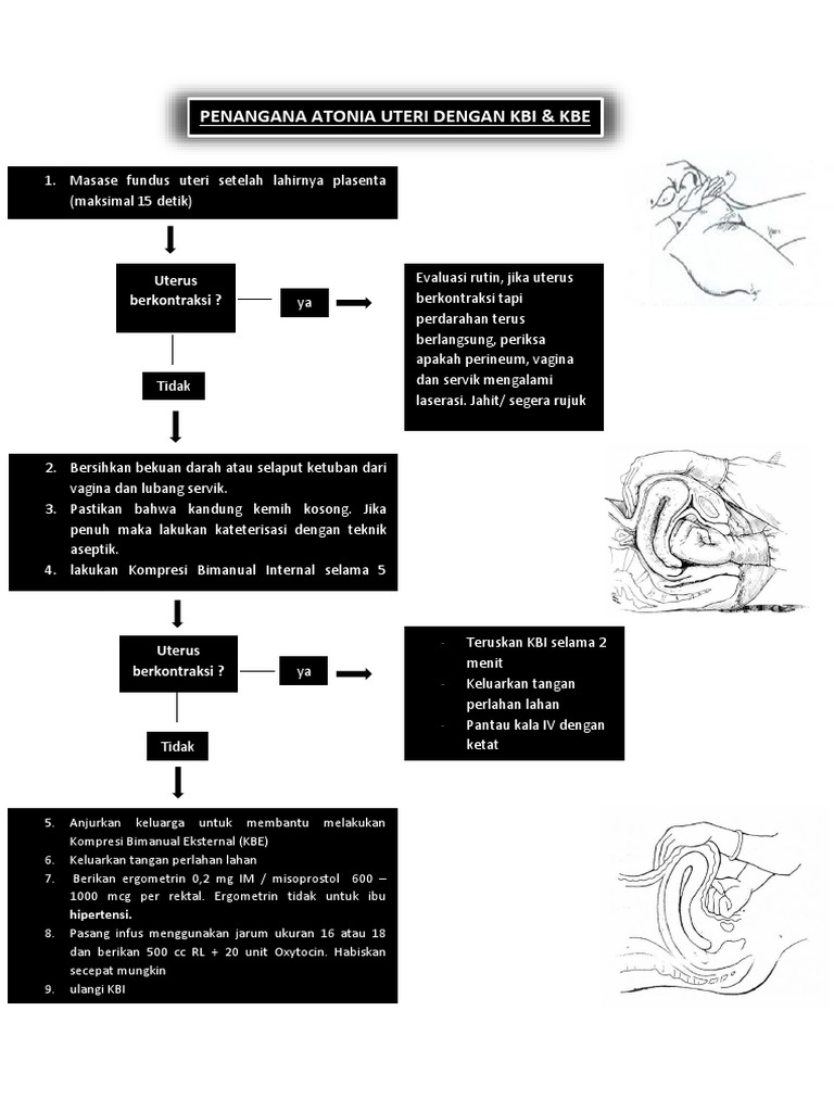 Penangana Atonia Uteri Dengan Kbi & Kbe | PDF