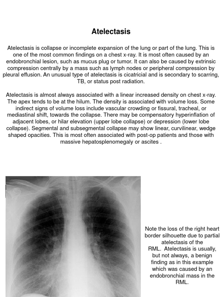 Lung Collapse Types and Signs on Chest X-Ray | PDF | Lung | Medicine