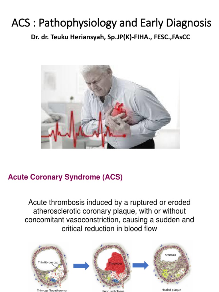 Acs: Pathophysiology and Early Diagnosis: Dr. Dr. Teuku Heriansyah, SP ...