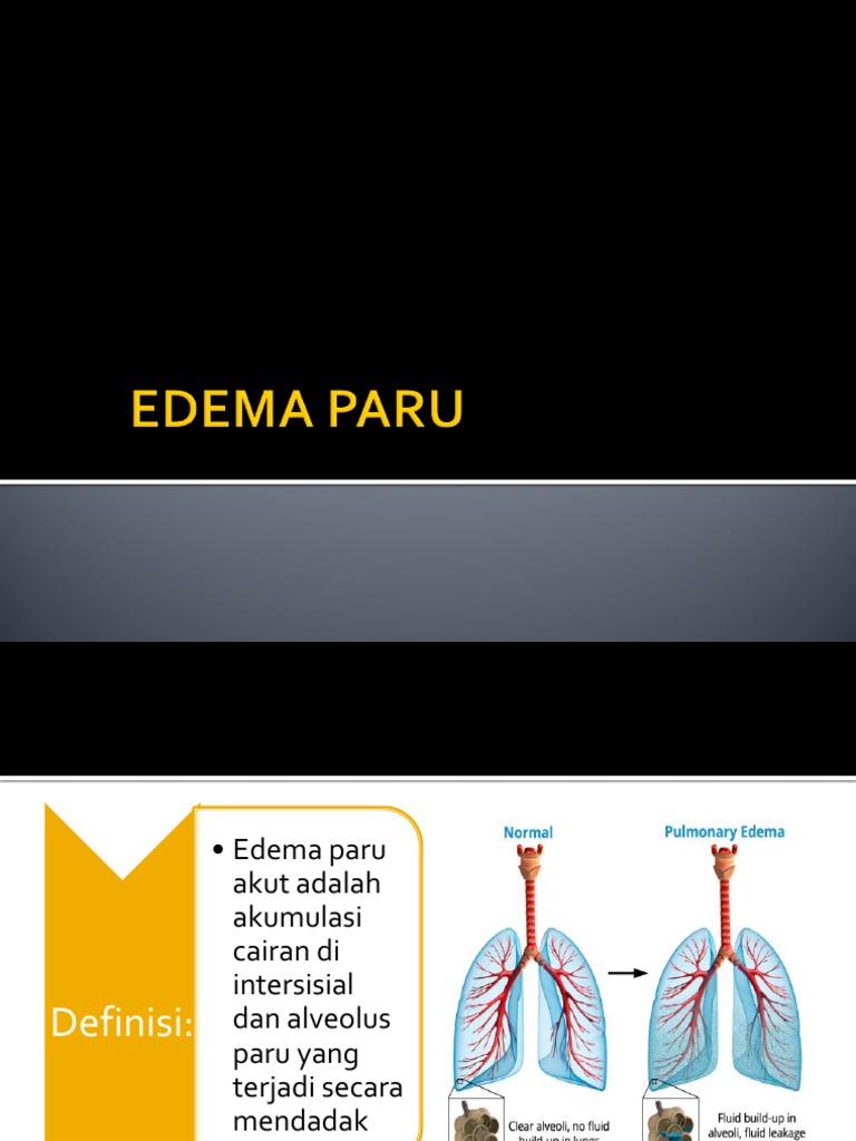 Edema Paru | PDF