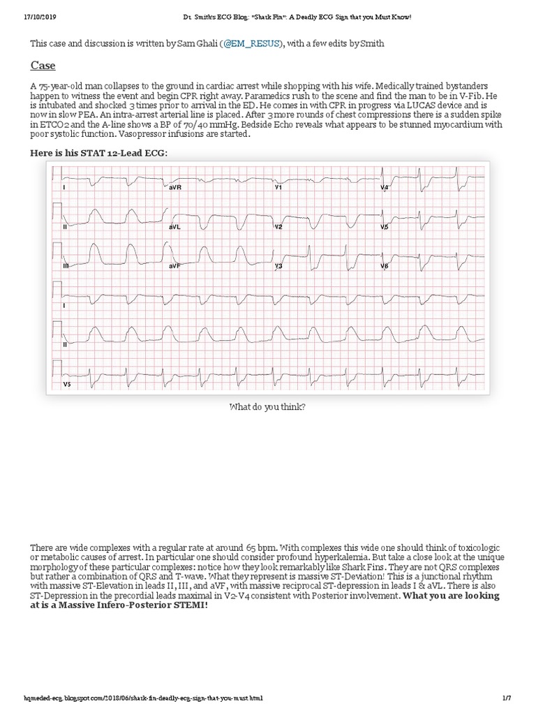 Dr. Smith's ECG Blog - "Shark Fin" - A Deadly ECG Sign That You Must ...