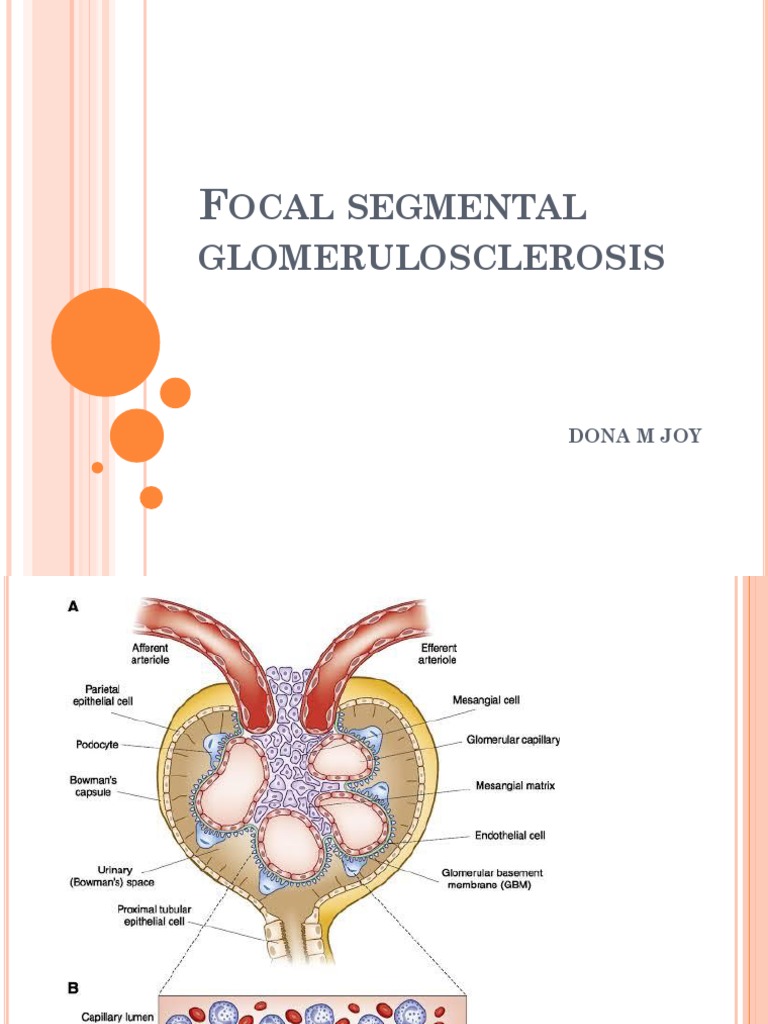 Focal Segmental Glomerulosclerosis | PDF