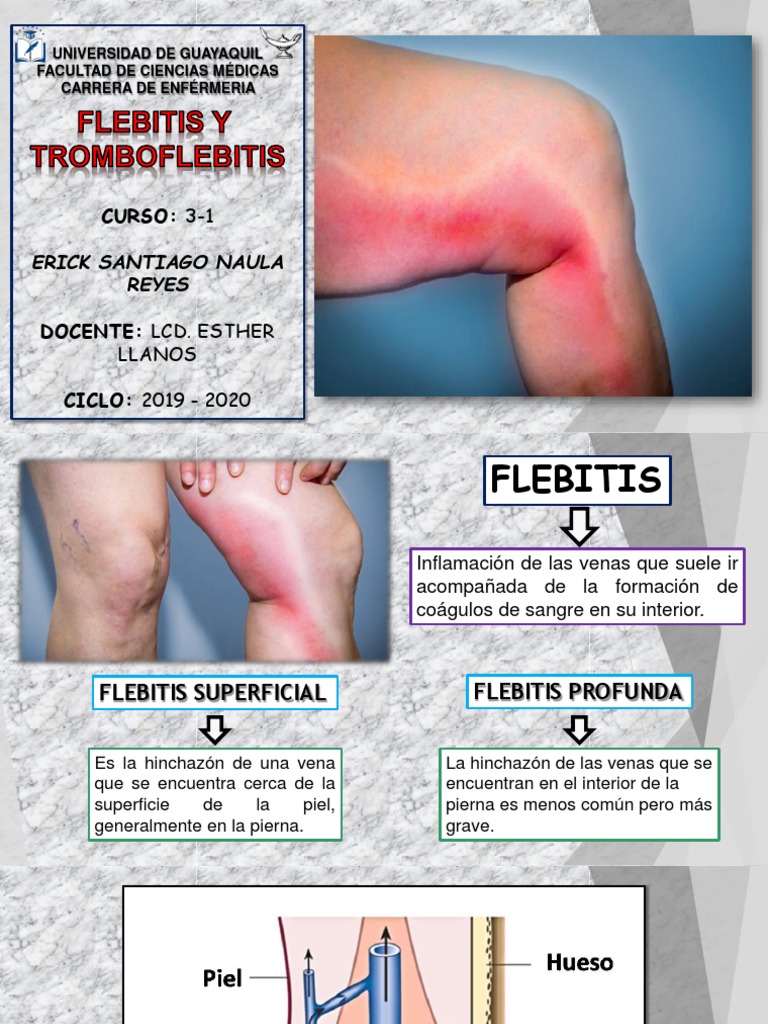 FLEBITIS | PDF | Venas varicosas | Epidemiología