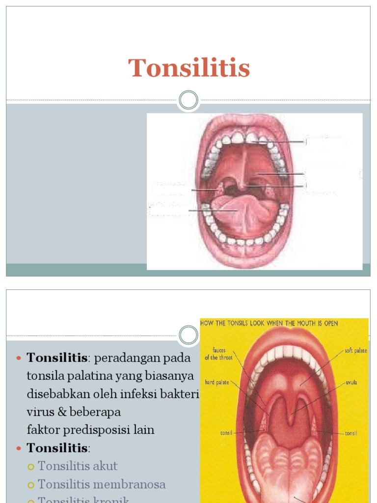 TONSILITIS | PDF | Sains & Matematika