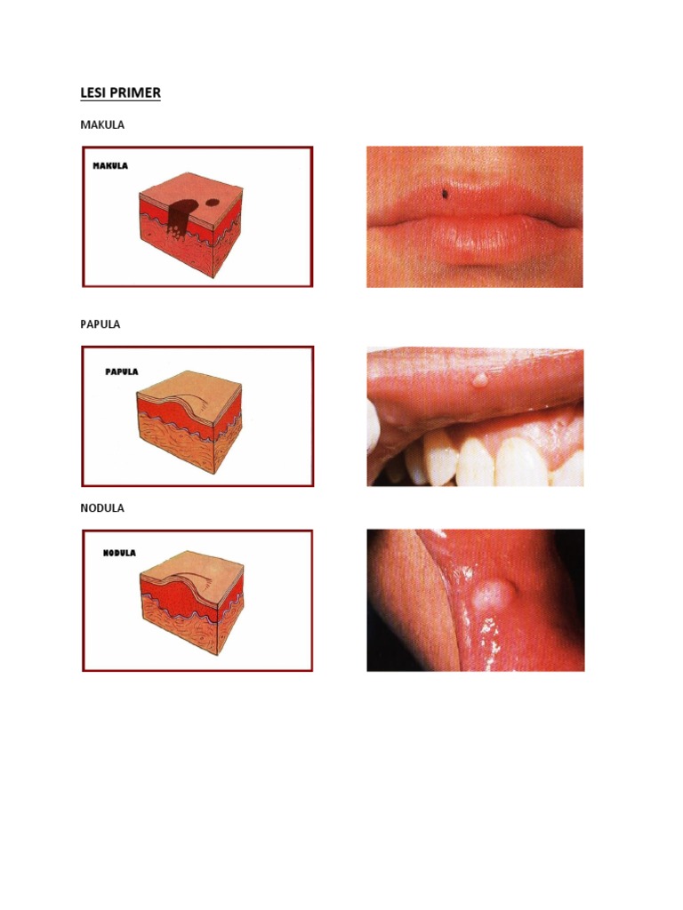 Lesi Primer: Makula | PDF