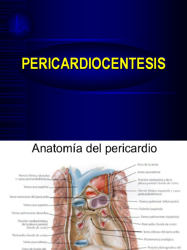 PERICARDIOCENTESIS | PDF