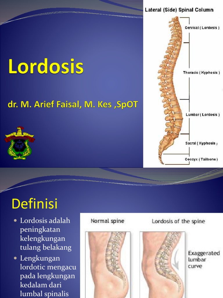 LORDOSIS | PDF