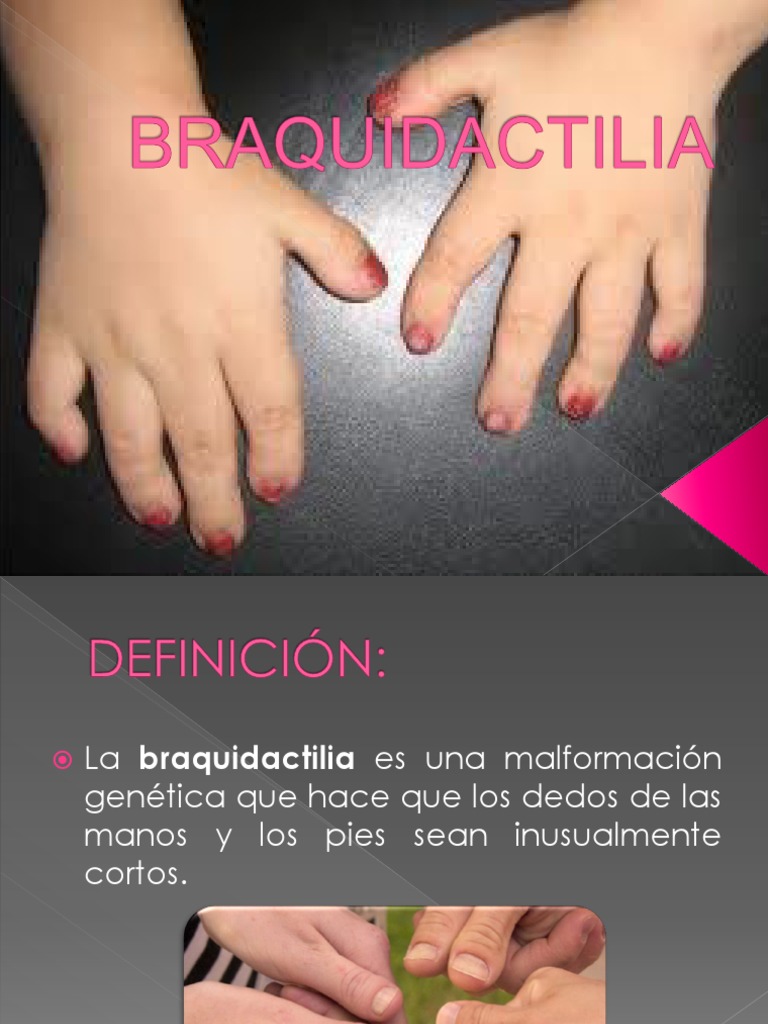 Braquidactilia | PDF